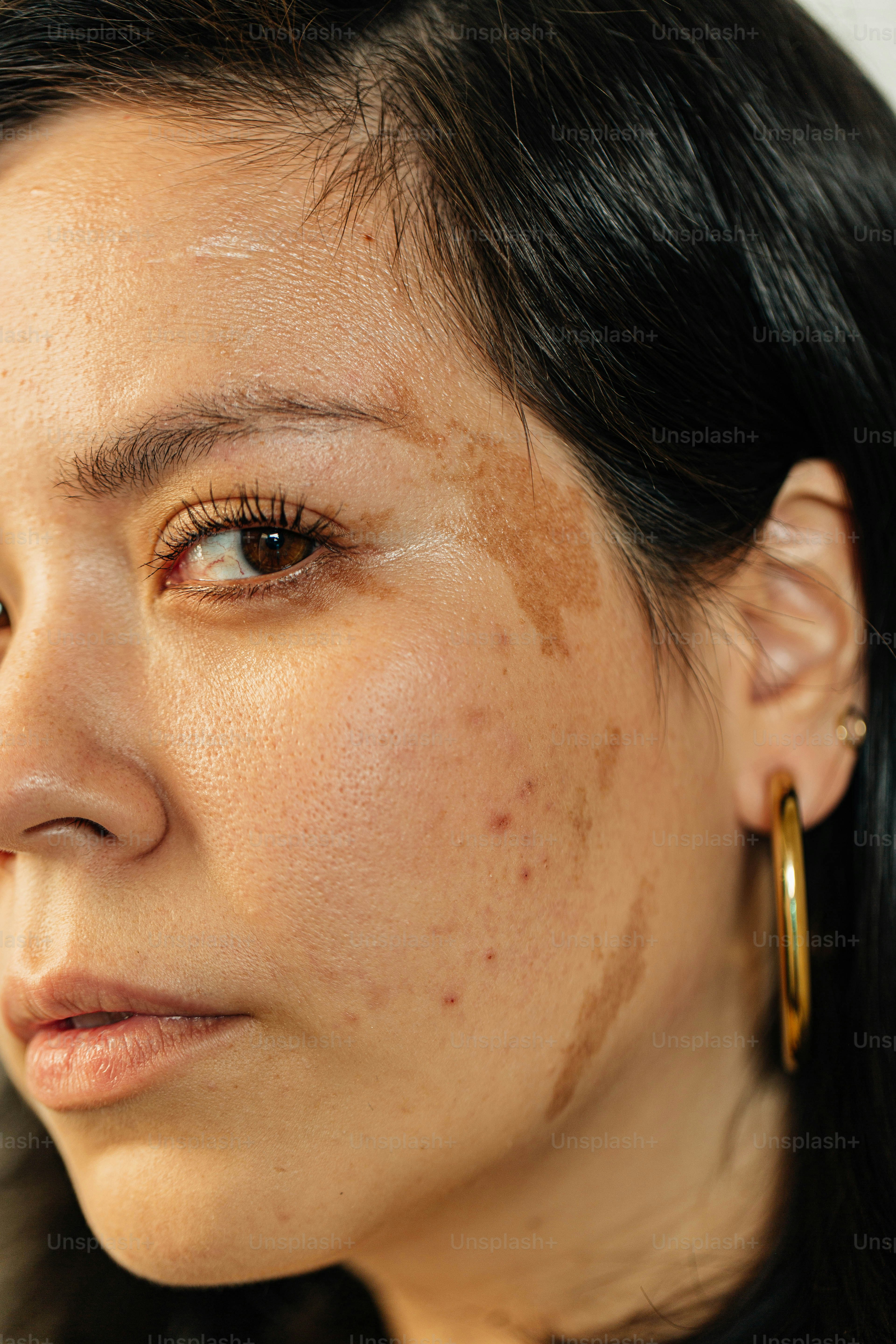 Acne Scars Pictures | Download Free Images on Unsplash