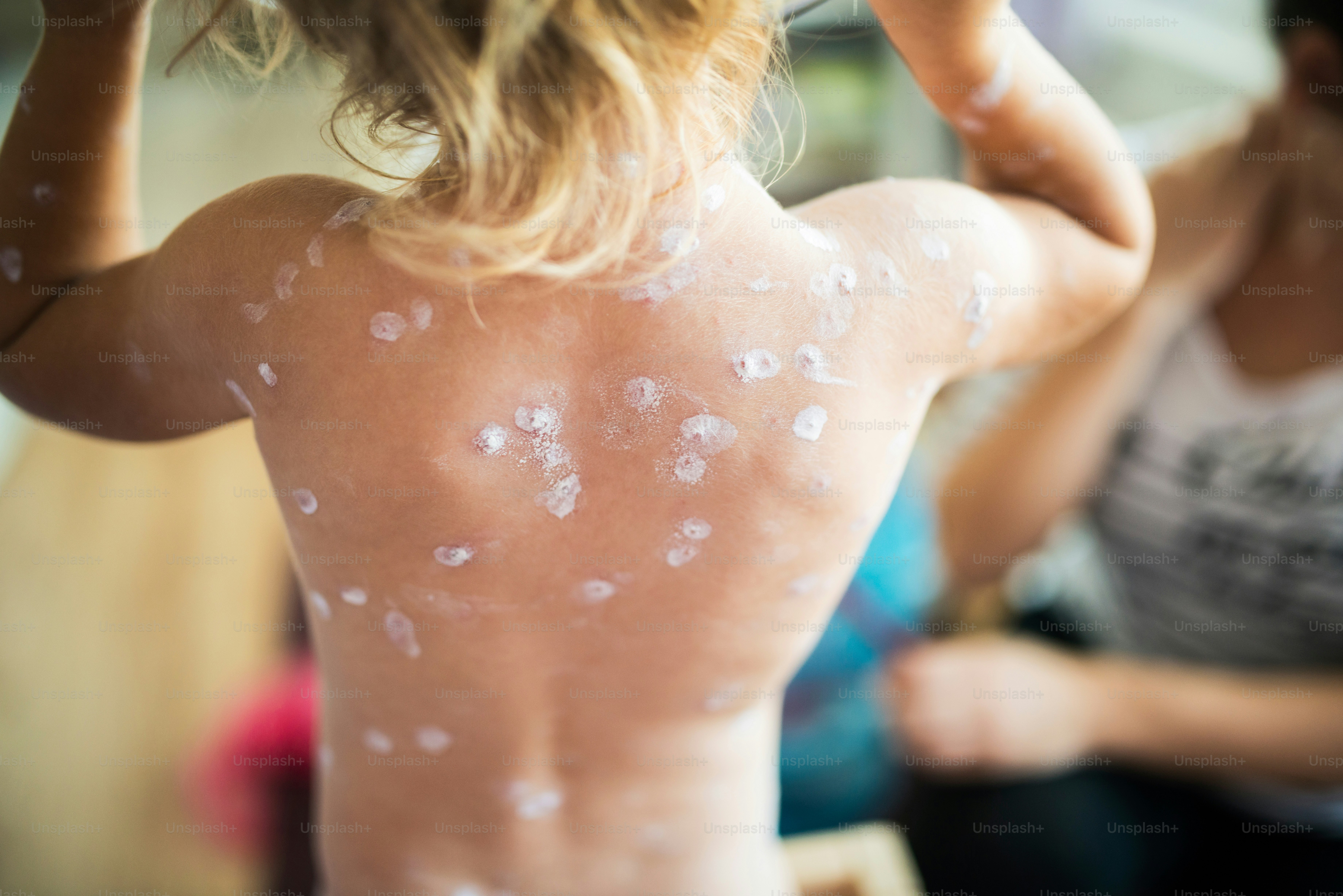 Back of little two year old girl at home sick with chickenpox. White ...