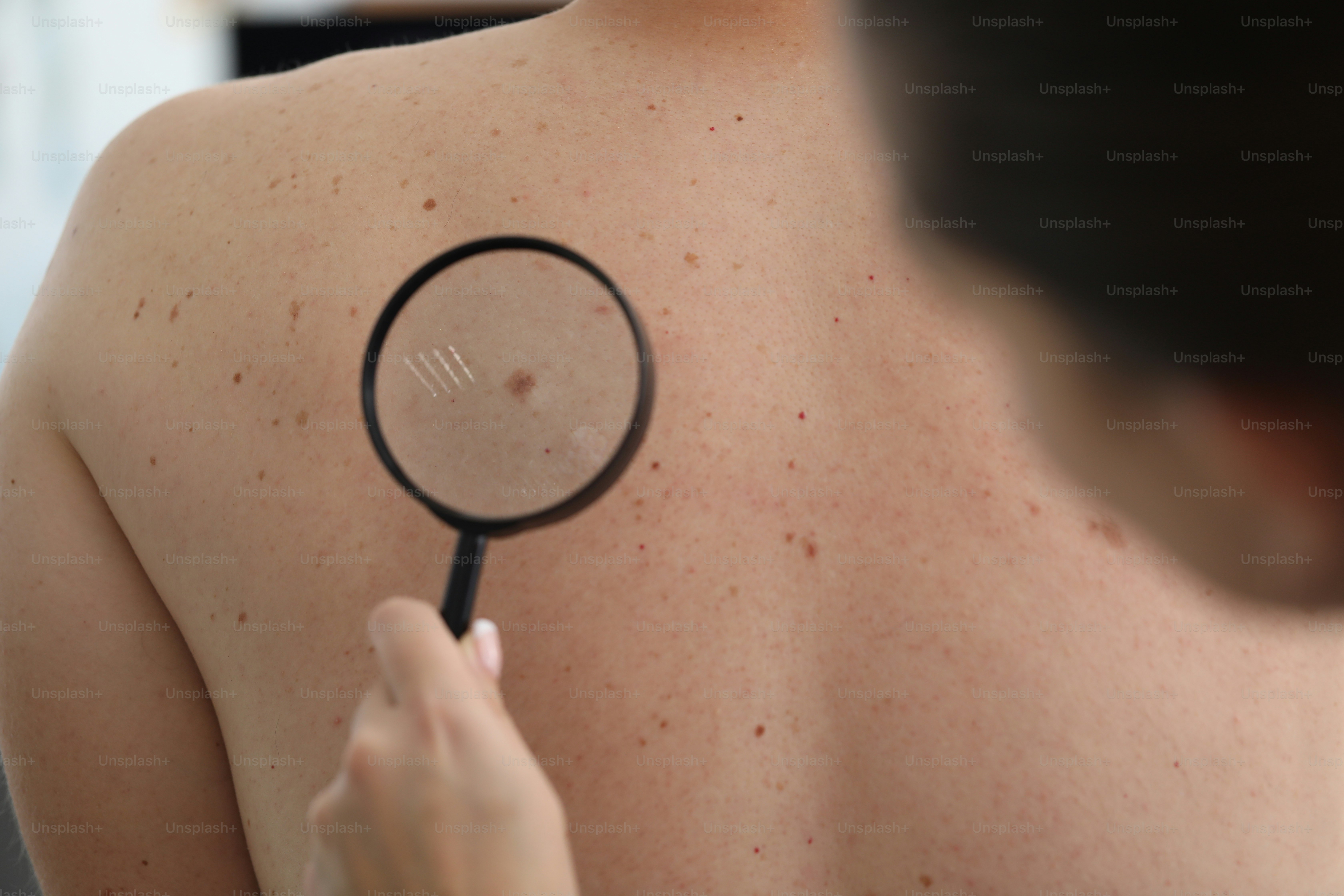 Close-up of dermatologist doctor examines birthmark of patient on back ...