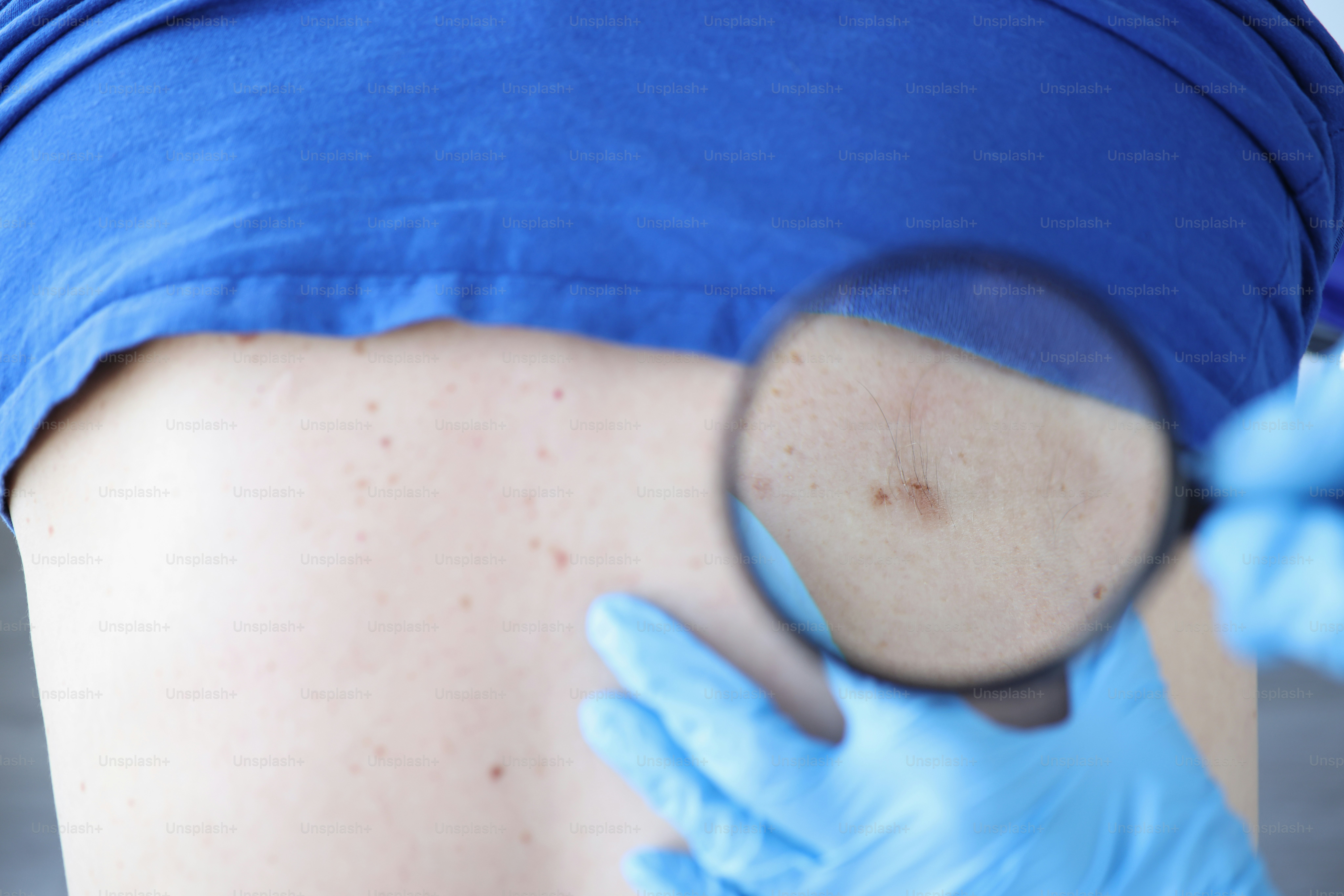 Doctor examines patient's back with moles through magnifying glass ...