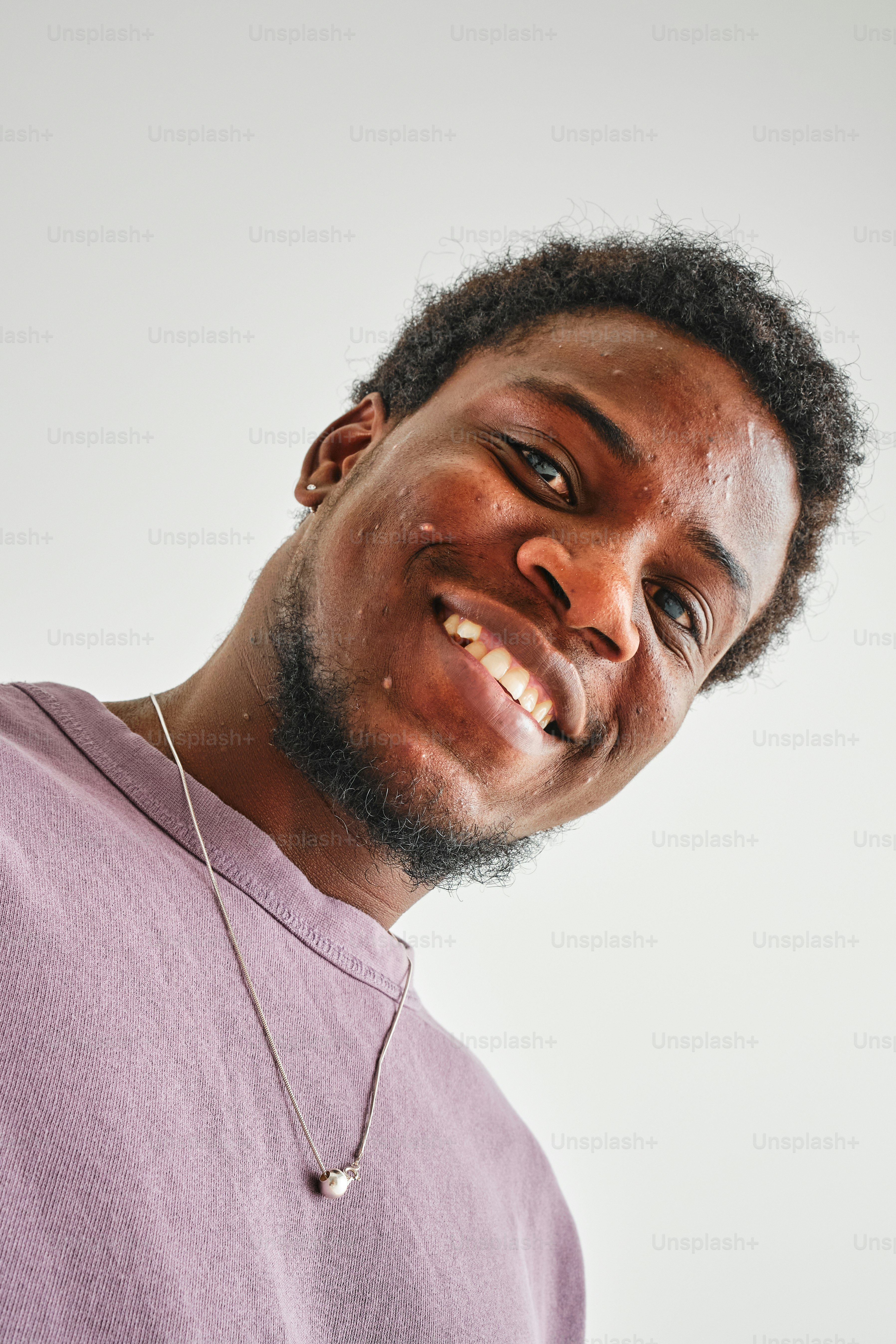 A man with a beard smiling for the camera photo – Acne scars Image on ...