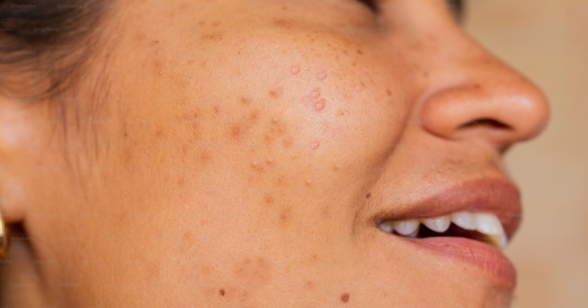 Un Primer Plano De Una Mujer Con Pecas En La Cara Foto Imagen De Cara