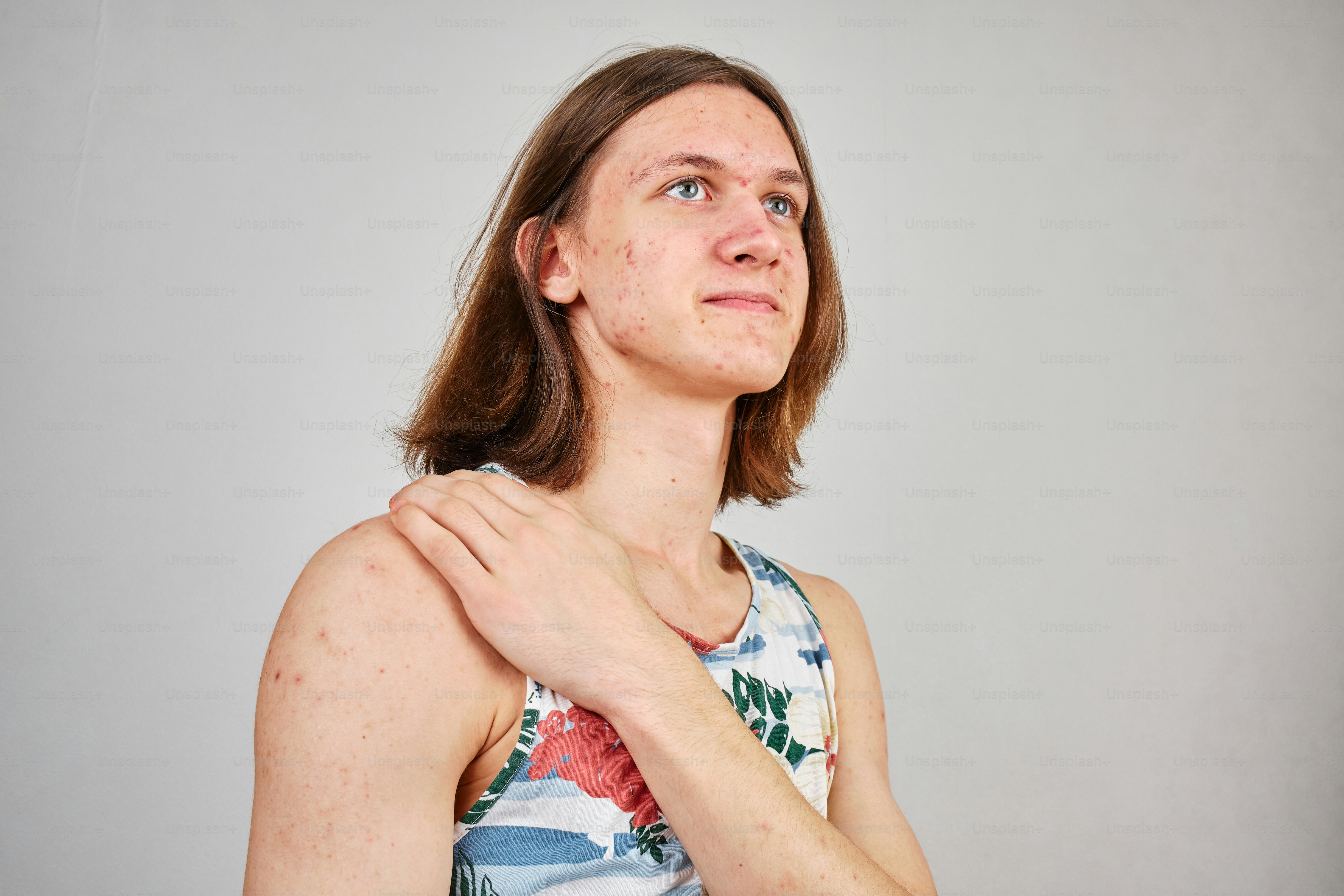 A woman holding her arm around her neck photo – Acne scars Image on ...