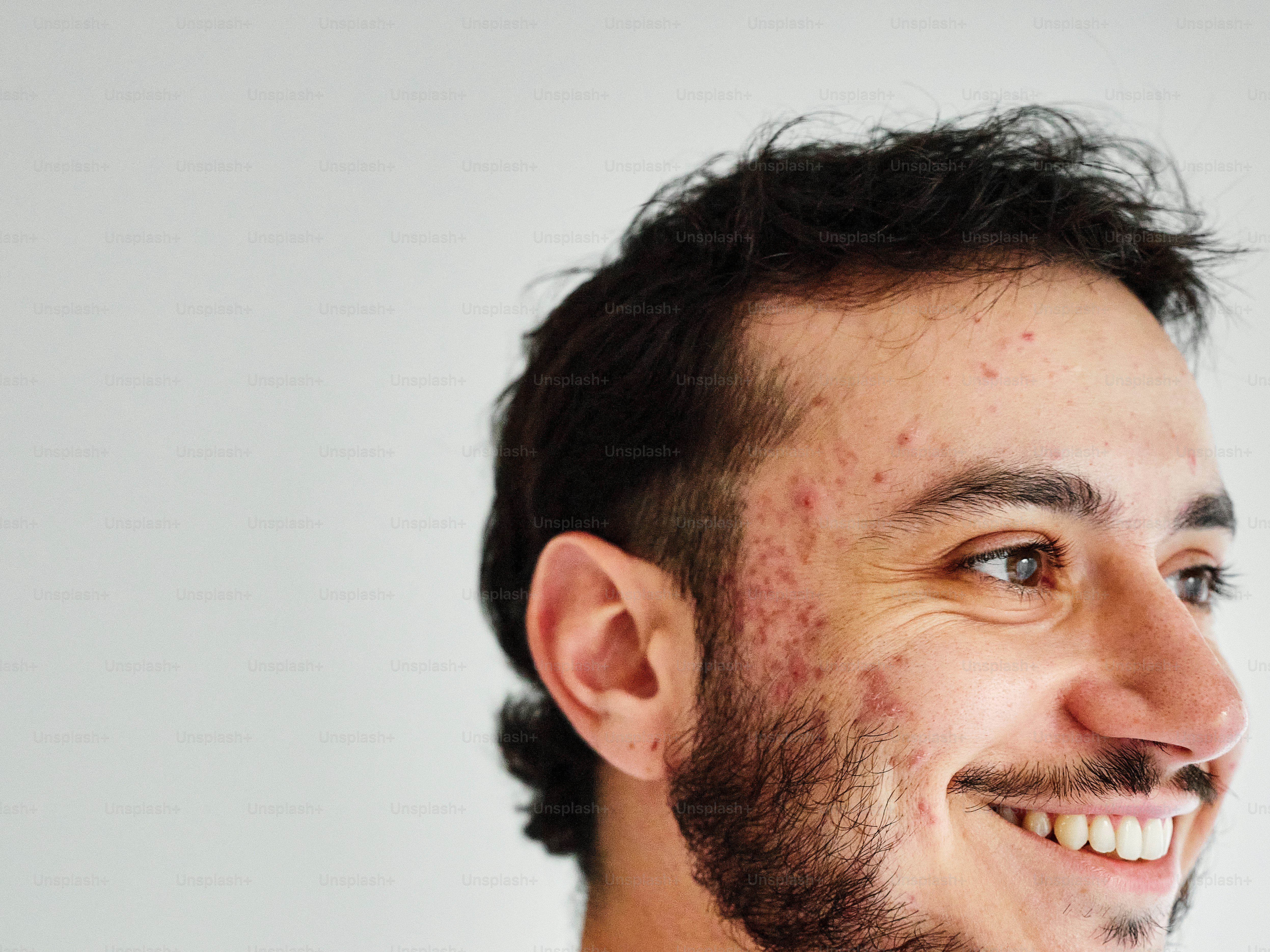 A man with freckles on his face smiling photo – Transgender Image on ...