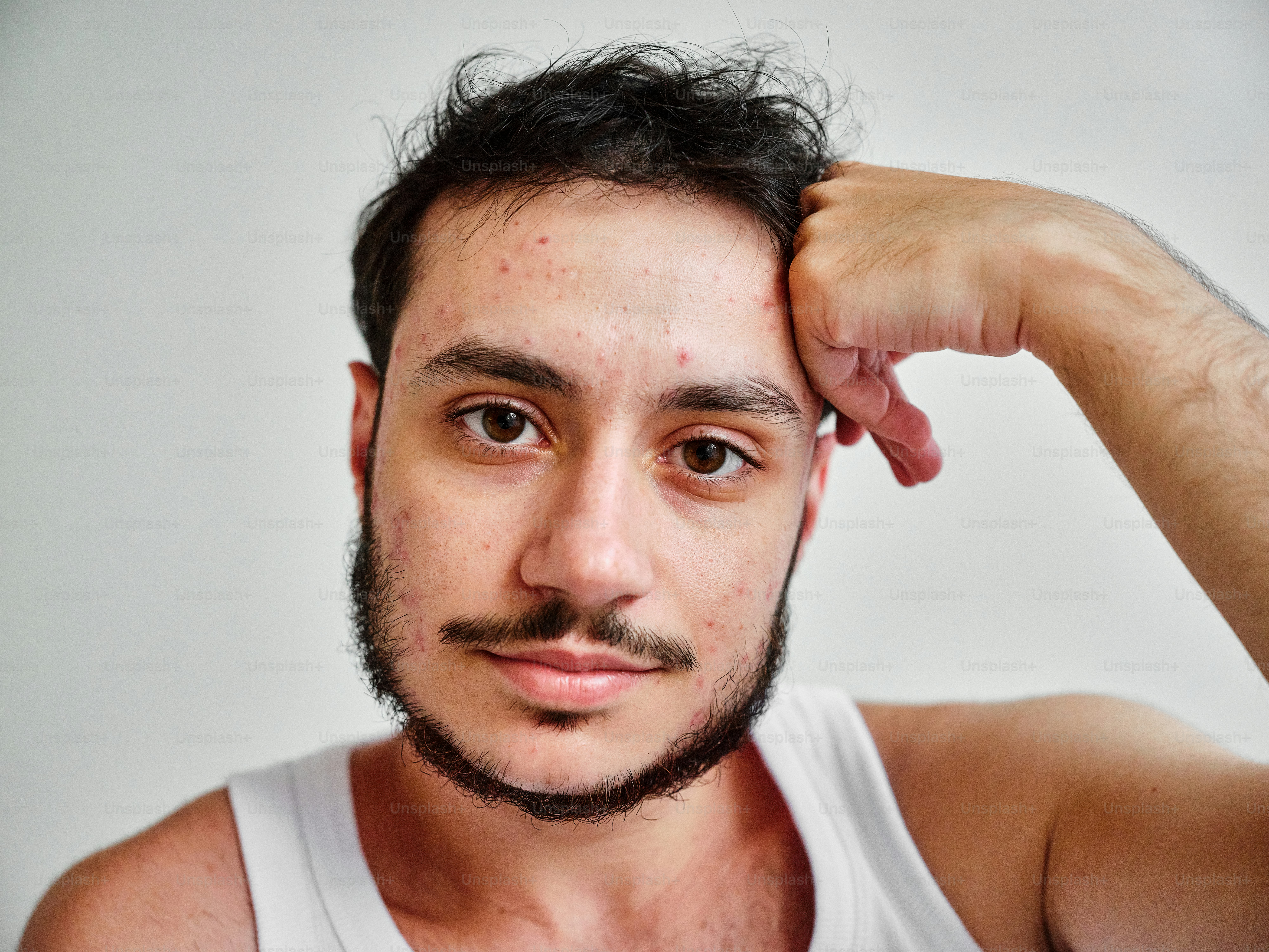 A man with a goatee and a beard posing for a picture photo – Acne scars ...