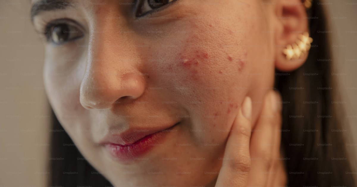 Un Primer Plano De Una Mujer Con Acné En La Cara Foto Imagen De