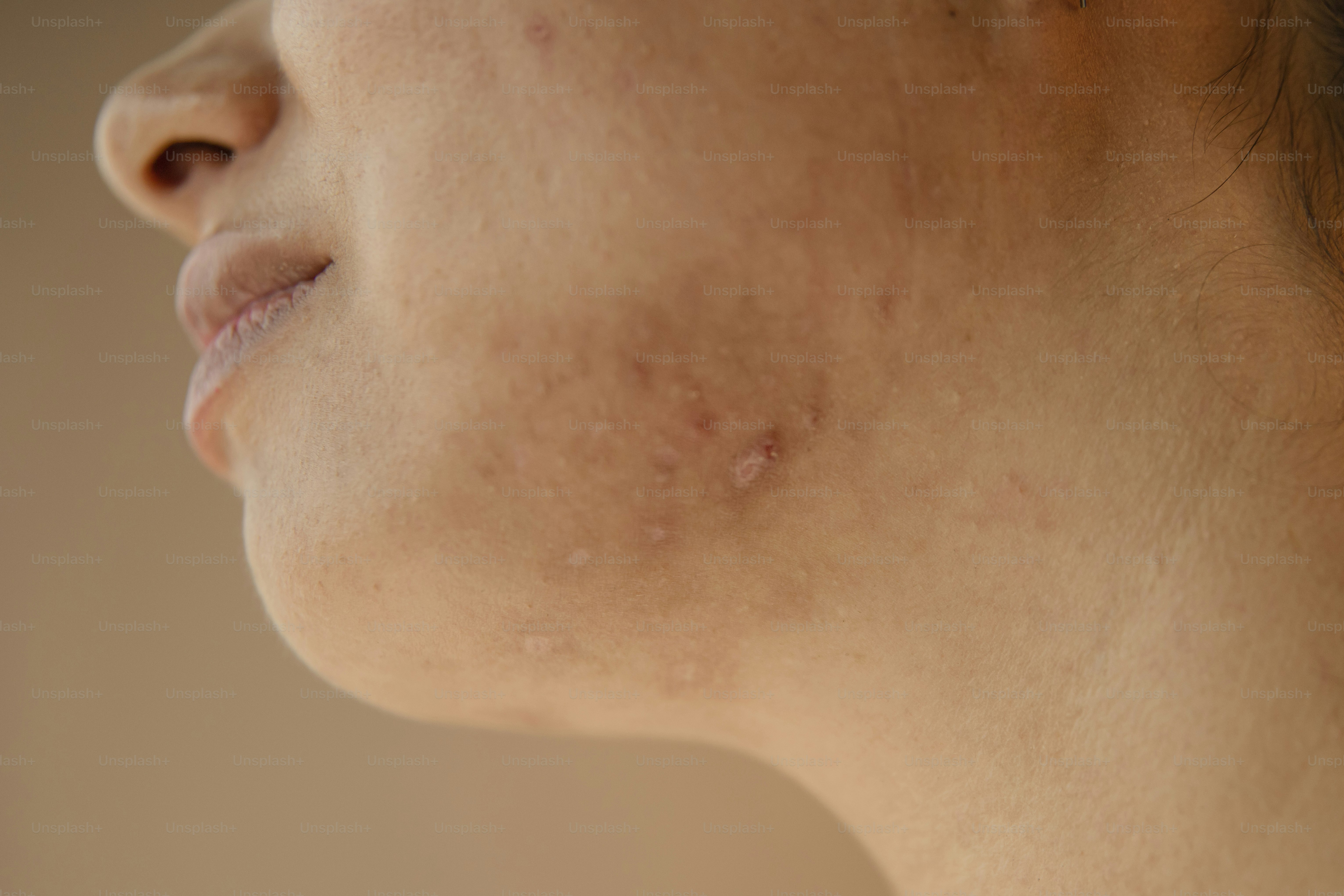 A woman with acne on her face photo – Acne scars Image on Unsplash