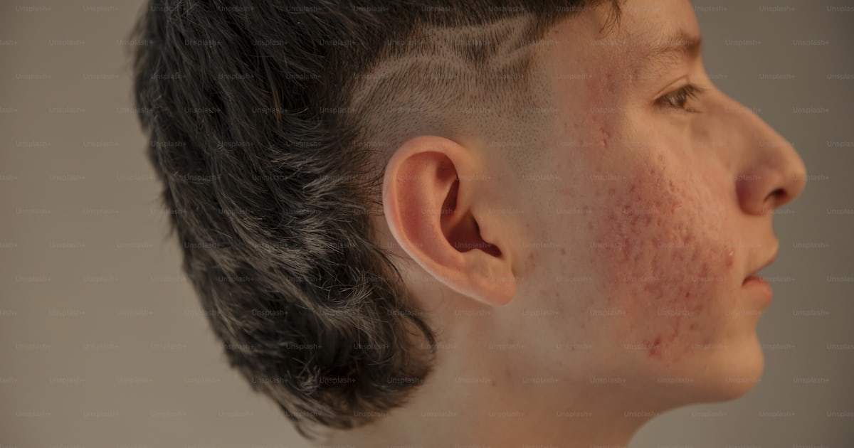 Un Primer Plano De Una Persona Con Pecas En La Cara Foto Imagen De
