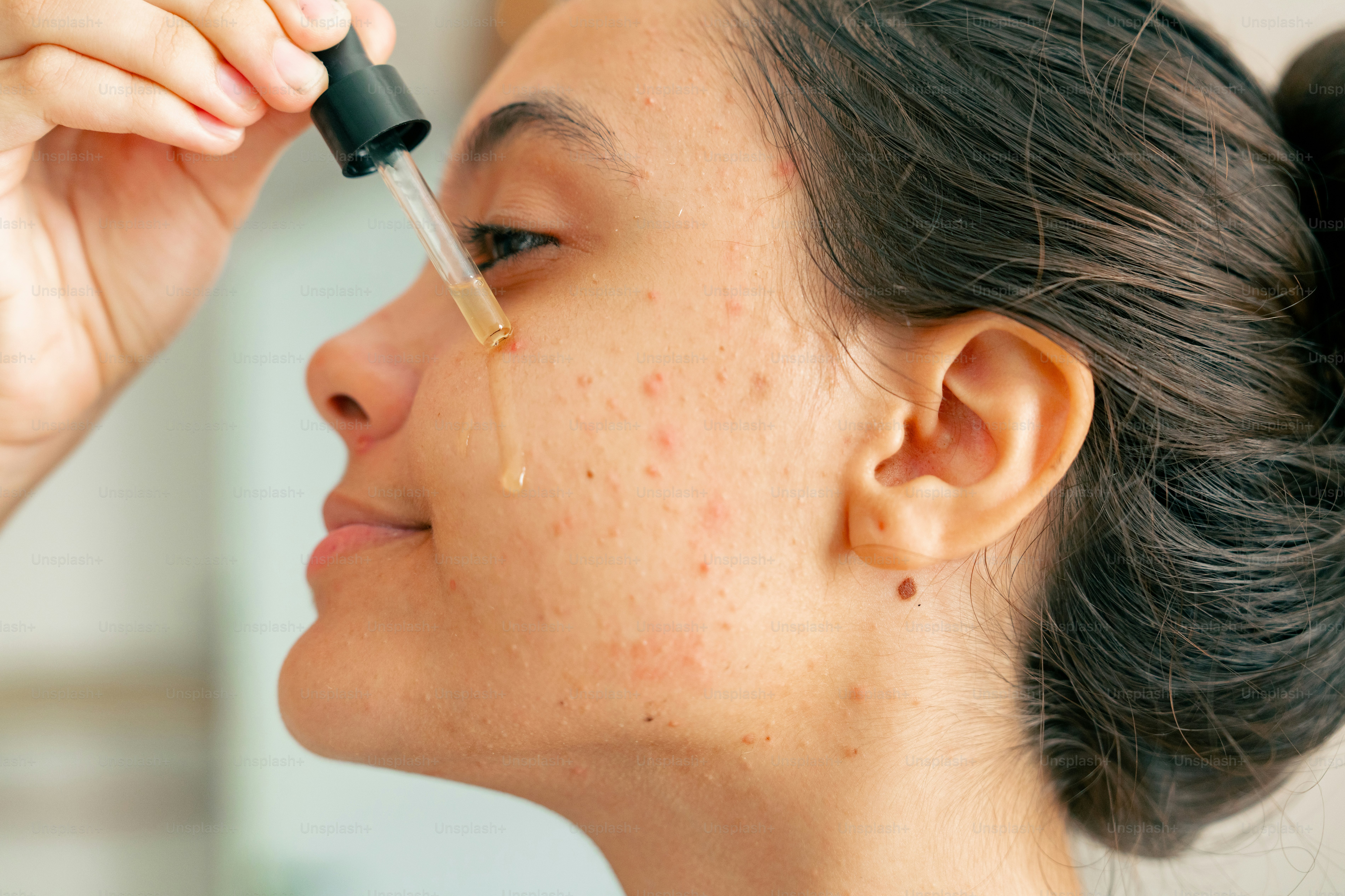 Uma mulher com acne no rosto e uma gota de óleo no nariz foto – Imagem ...