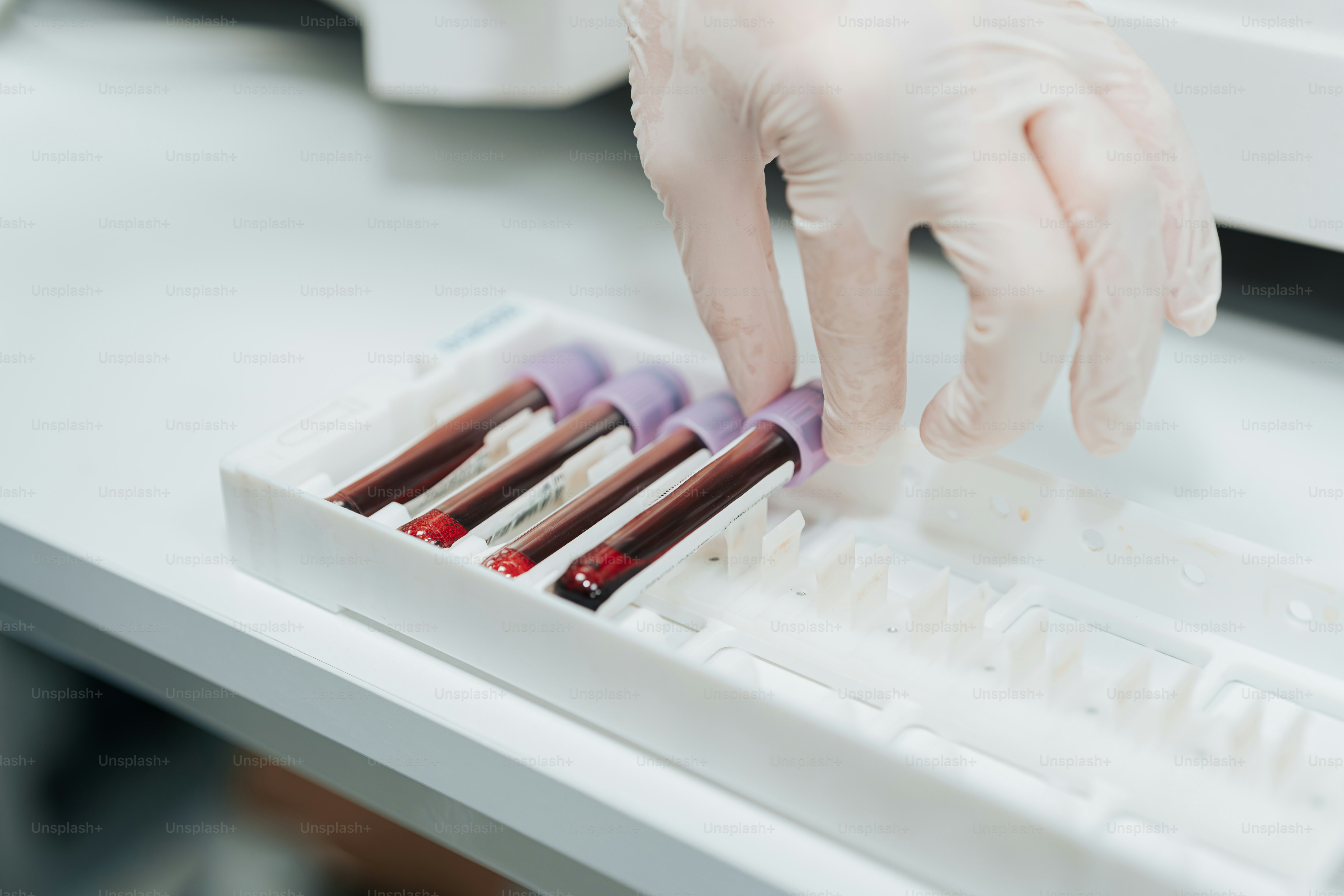 A person in white gloves is putting blood into a tube photo – Blood ...