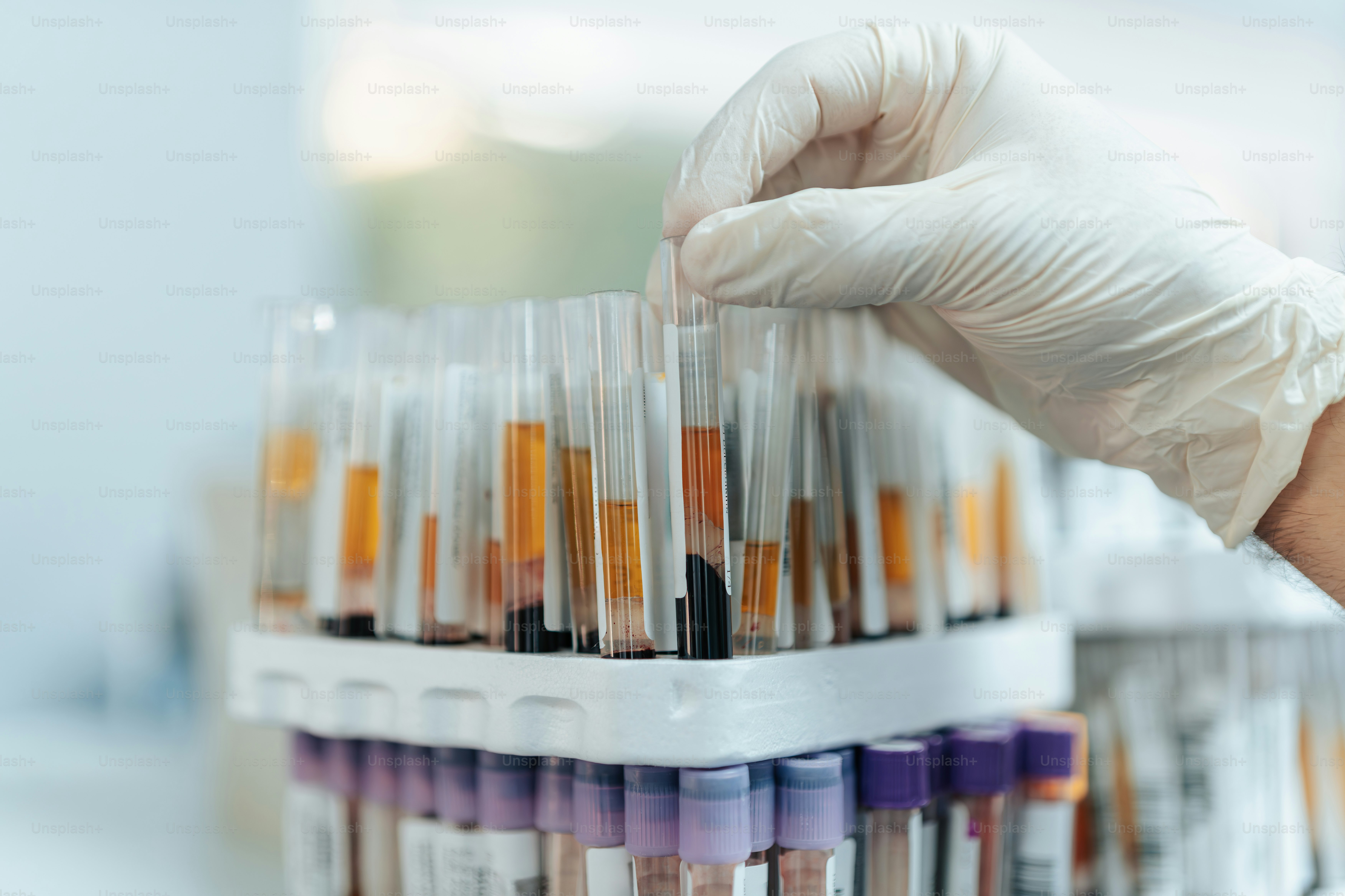 A person with blue gloves is getting a blood test photo – Blood test ...