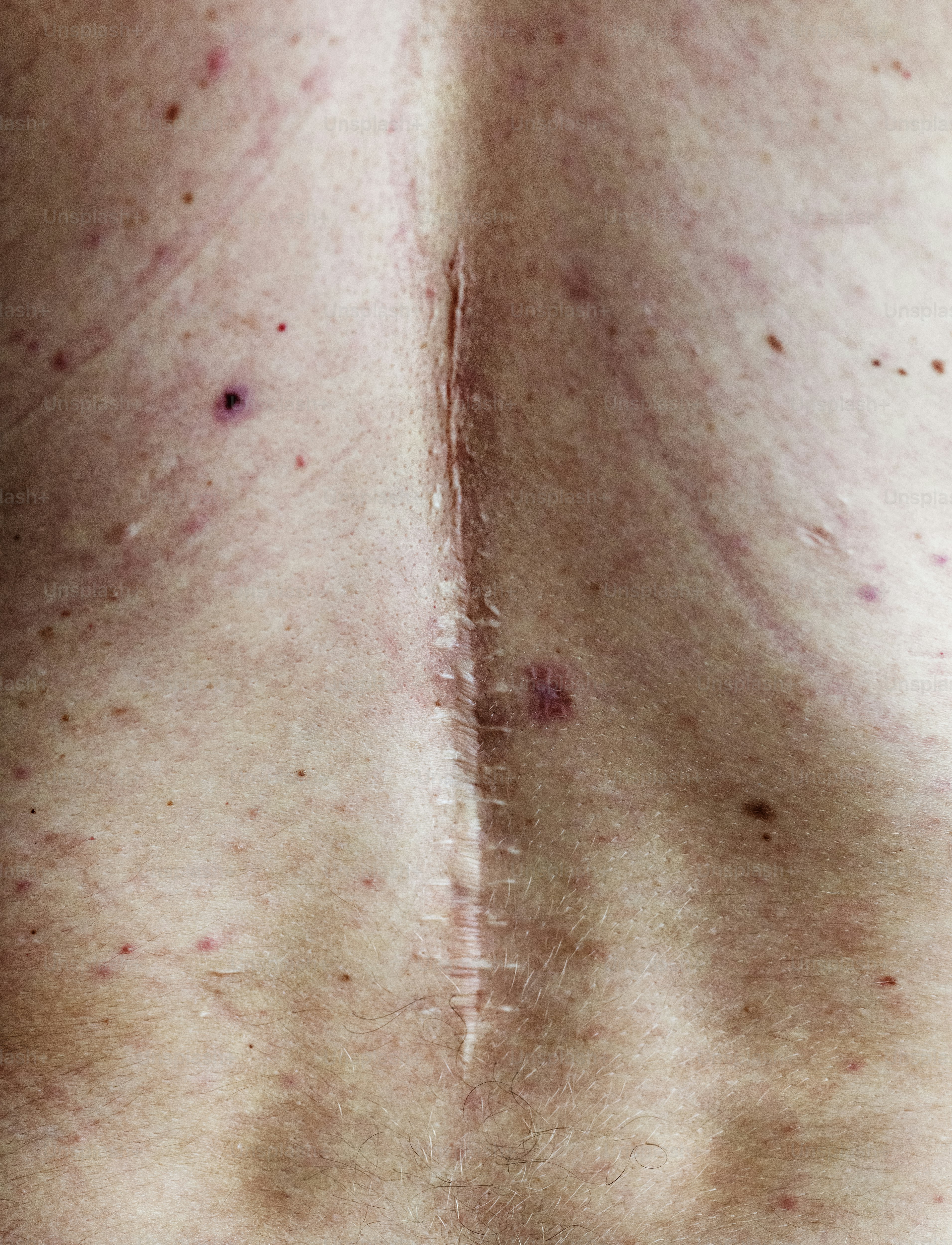 Elderly person back surgery scar photo – Spine - body part Image on ...