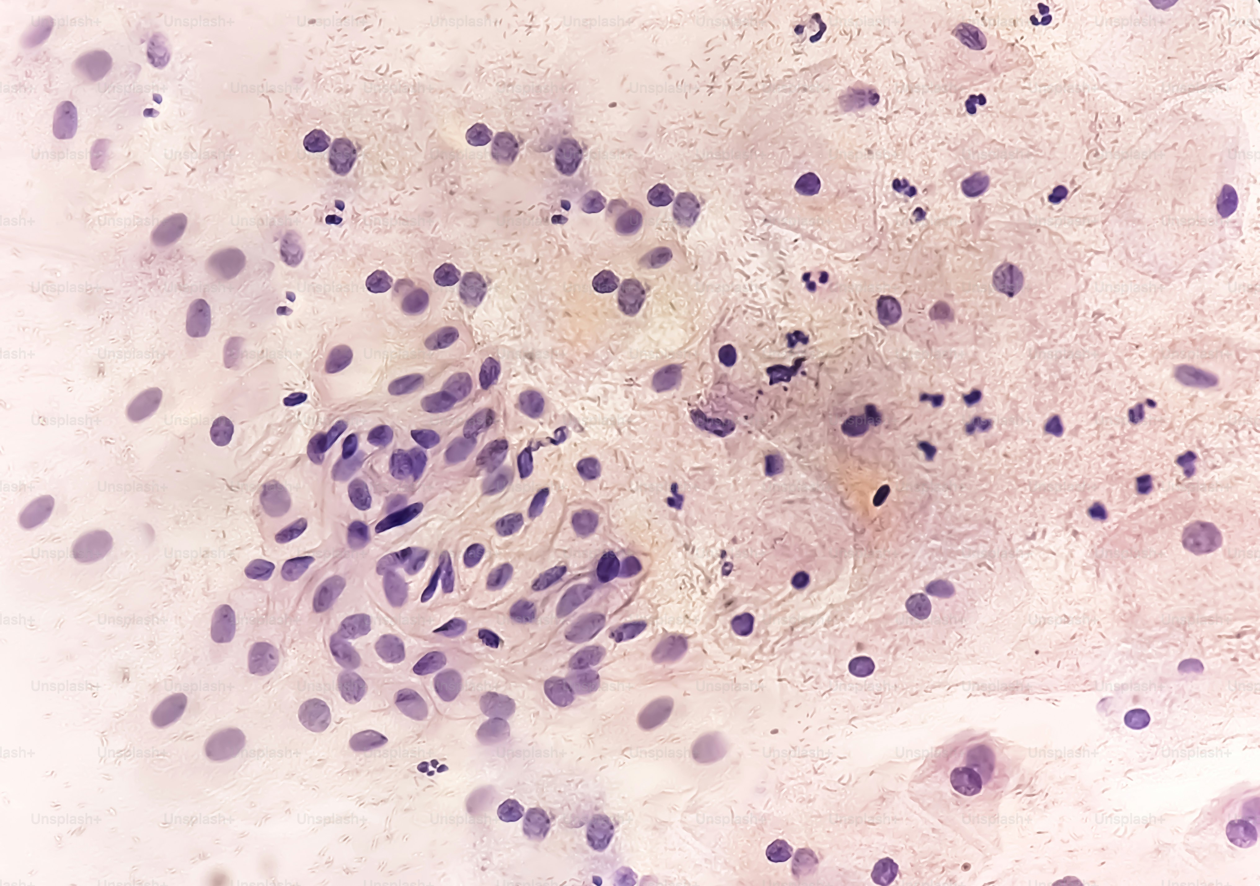 Paps smear: NILM with reactive cellular changes associated with ...