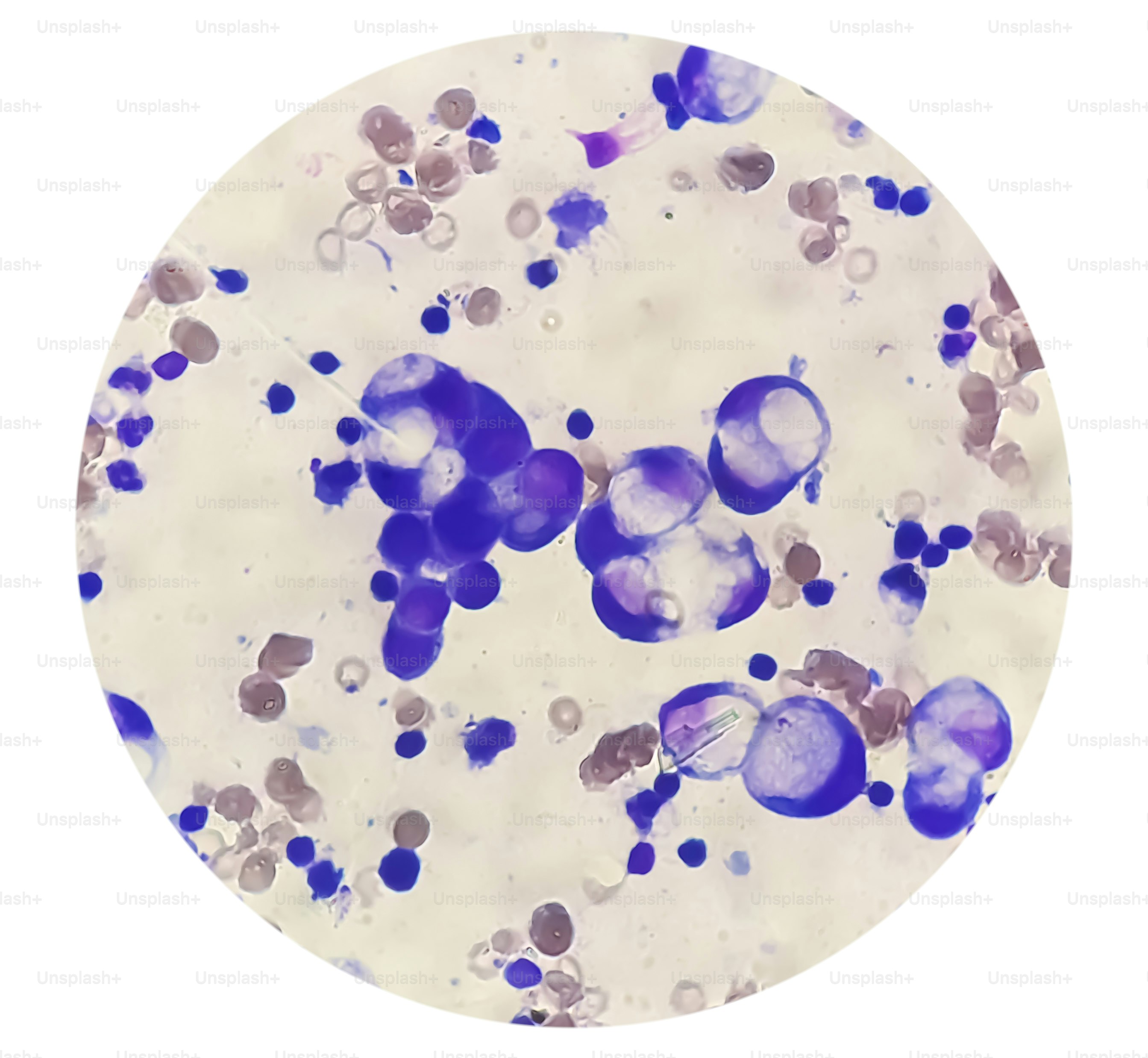 Malignant fluid cytology; Cells of adenocarcinoma may spread to fluid ...