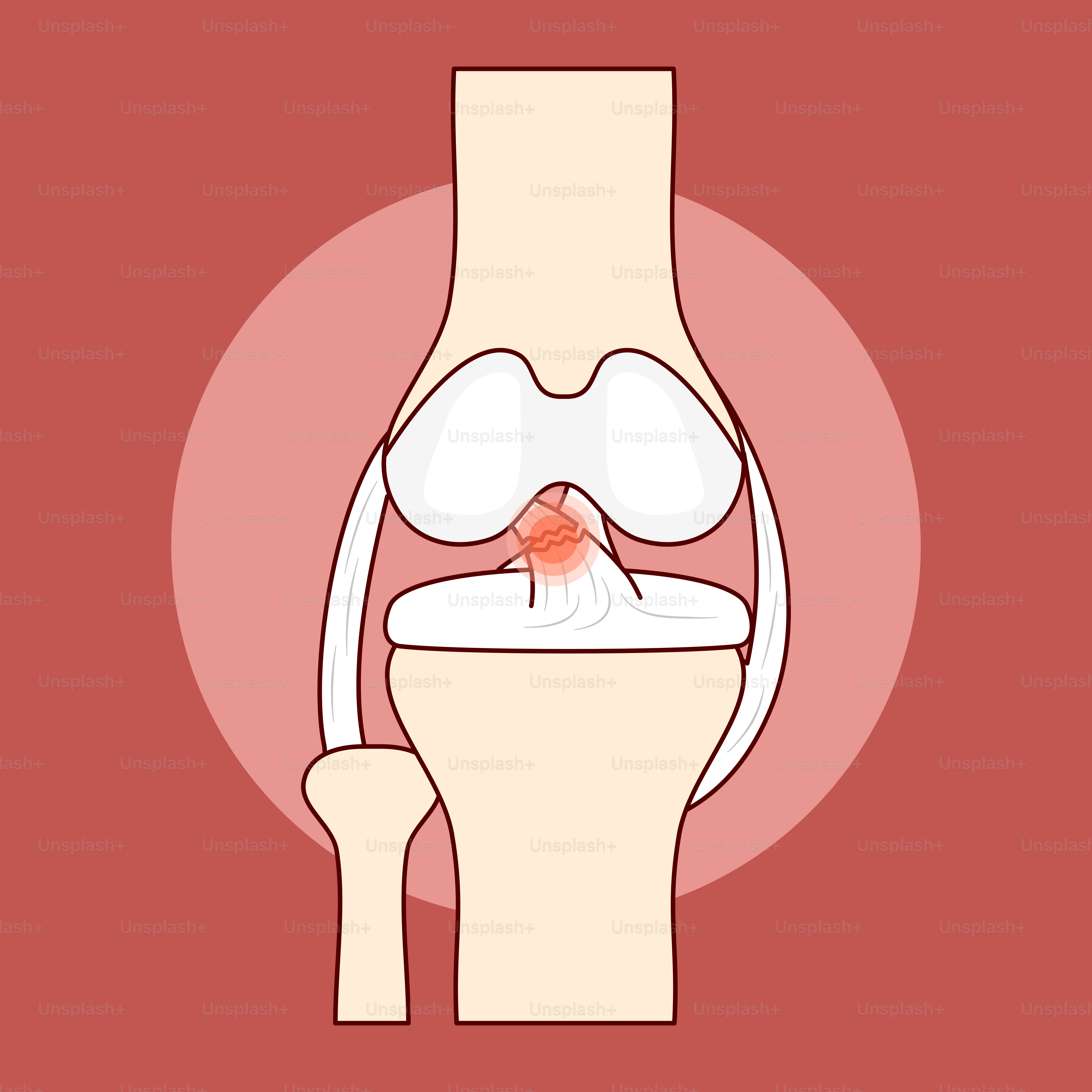 Una imagen de una rodilla con una mancha roja vector – Imagen de Acl en ...